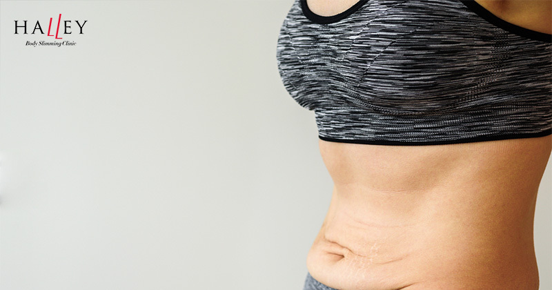 How to Get Rid of Loose Skin After Weight Loss | Halley Body Slimming